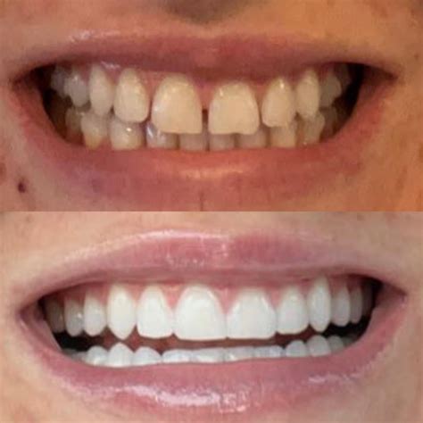 Done 20 Initial Trays And 6 Refinement Trays So Worth It R Invisalign