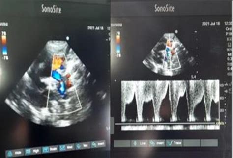 Suprasternal View On Echo S O All 4 Pulmonary Veins Draining Via Download Scientific Diagram