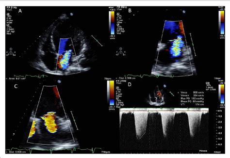 Figure 1 From Criteria For Mitral Regurgitation Classification Were