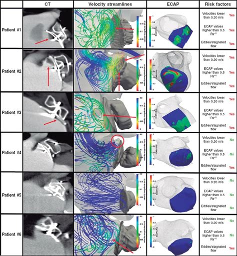 Patient Specific Flow Simulation Analysis To Predict Device Related Thrombosis In Left Atrial