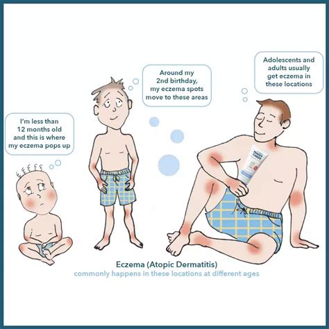 Ringworm Vs Eczema What Are The Differences