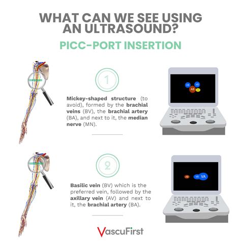 Tips For Proper PICC Port Placement VascuFirst