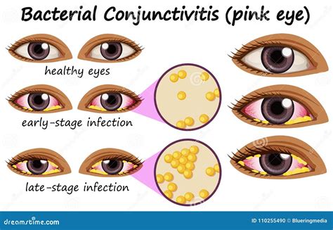 Diagram Showing Bacterial Conjunctivitis In Human Eye Stock Vector