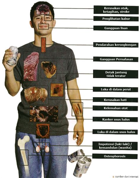 Sehat Itu Mahal Bahaya Minuman Keras