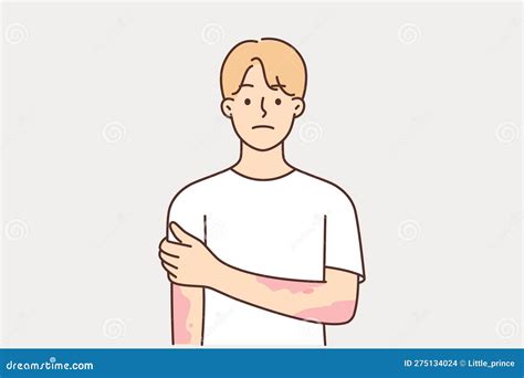 Man Suffering From Dermatitis And Skin Diseases With Spots On Hands