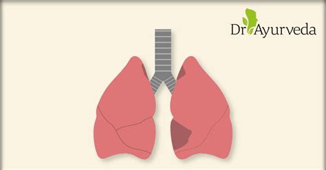 Dr Ayurveda Official Important Herbs For Tuberculosis