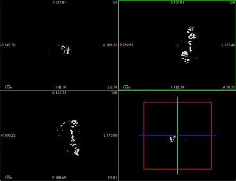 Issue With Brain Segmentation Image After Using Imagemath Issue