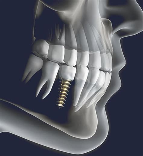 Zubni implantati - Nobel Biocare . Neodent . Dentus perfectus