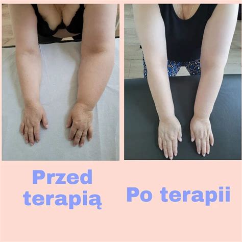 Obrzęk limfatyczny leczenie ZDROWE net