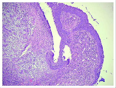 Histological Sections Case 2 Showing A Polypoid Nodule Consisting Of Download Scientific