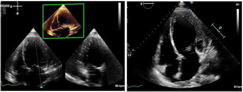 Figure 1 Transthoracic Echo Showing Normal Left Ventricular Wall