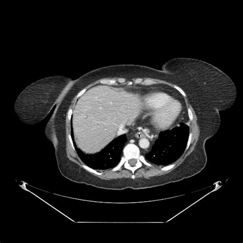 Closed Loop Small Bowel Obstruction Internal Hernia Radiopaedia