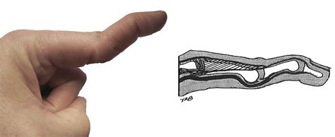 Swan Neck Deformity Richard Stephen Gilbert Md