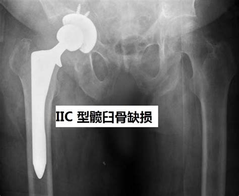 【人工全髋关节翻修术】髋臼缺损paprosky分型 转载骨缺损