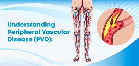 Understanding Peripheral Vascular Disease Pvd