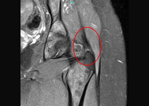 Hip Abductor Gluteus Tendon Repair Surgeon Los Angeles Orange