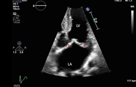 Zoomed In Transthoracic Echocardiogram With Apical Four Chamber View