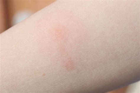 What Causes The Itch In Mozzie Bites And Why Do Some People Get Such A