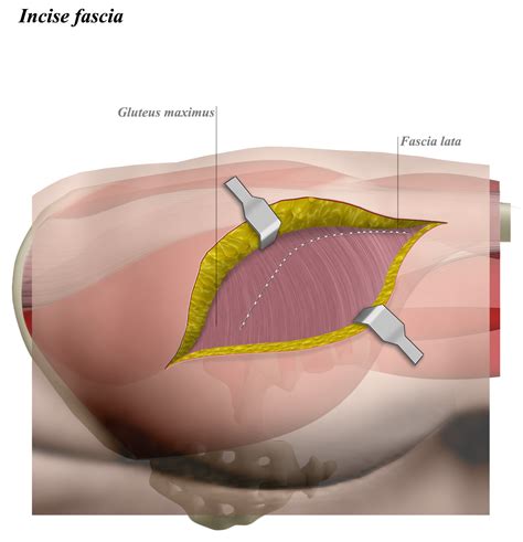 What Is Posterior Approach To Total Hip Replacement