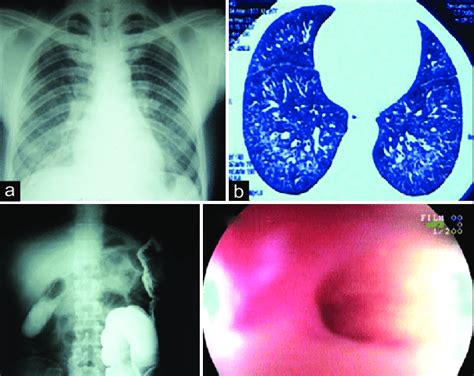 A Chest Radiograph Posteroanterior View Showing Bilateral