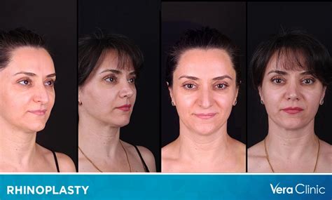 Rhinoplasty Cost A Comparative Analysis