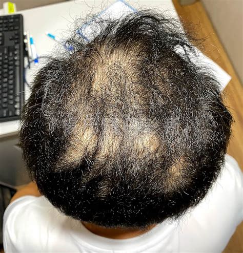 【複合式生髮】免植髮解除禿頭危機，實現頭髮茂密心願 楊氏診所 Udn部落格