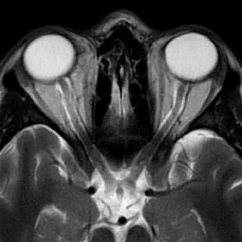 Normal Optic Nerve Mri