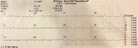 Normal Ecg In Seven Year Old Girl Ecg Guru Instructor Resources