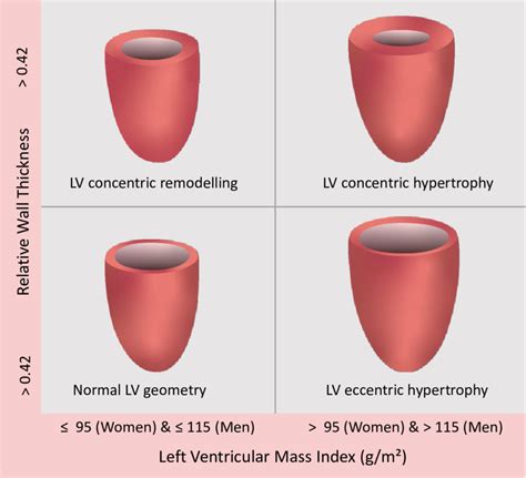 Sex Specific Lv Geometry Patterns According To Current Guidelines 10