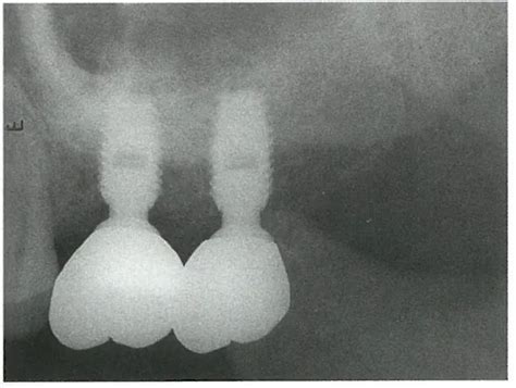 种植修复距离不足的解决办法 好医术文章 好医术 赋能医生守护生命