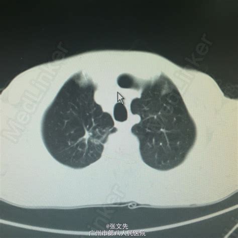 反复咳嗽咳痰气促9年余，加重3周