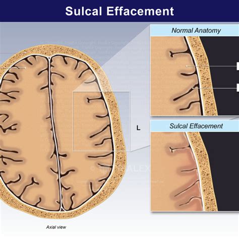Sulcal Effacement Trialexhibits Inc