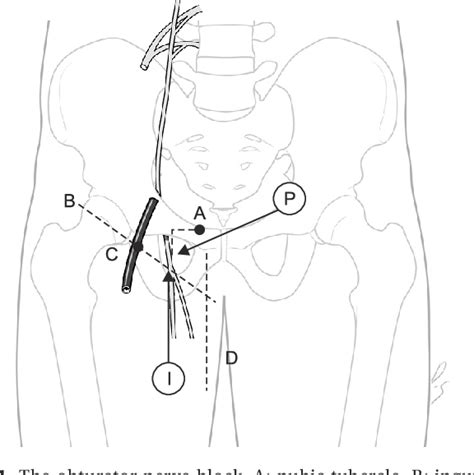 Figure 1 From Comparison Of The Success Rate Of Inguinal Approach With