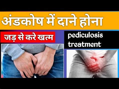 अडकष म दन हन andkosh mein dane hona pediculosis treatment