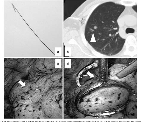 Figure 1 From Preoperative Localization Of Small Peripheral Pulmonary