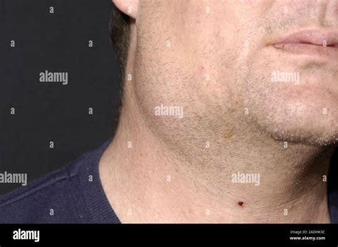 Mumps Swollen Gland Of A 40 Year Old Man With Mumps Parotitis A Viral Infection Of The Parotid