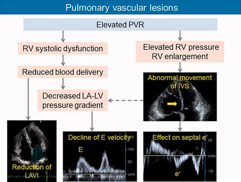 Schematic Interpretation Of The Hemodynamic Consequences Of Pulmonary