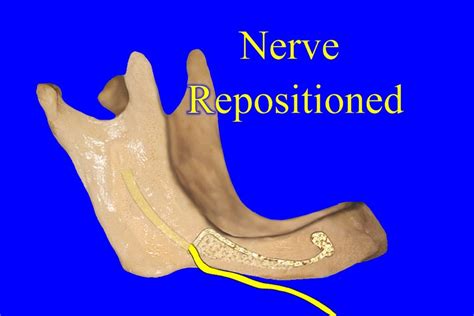 07 Nerve Repositioning Combined Stuart Orton Jones