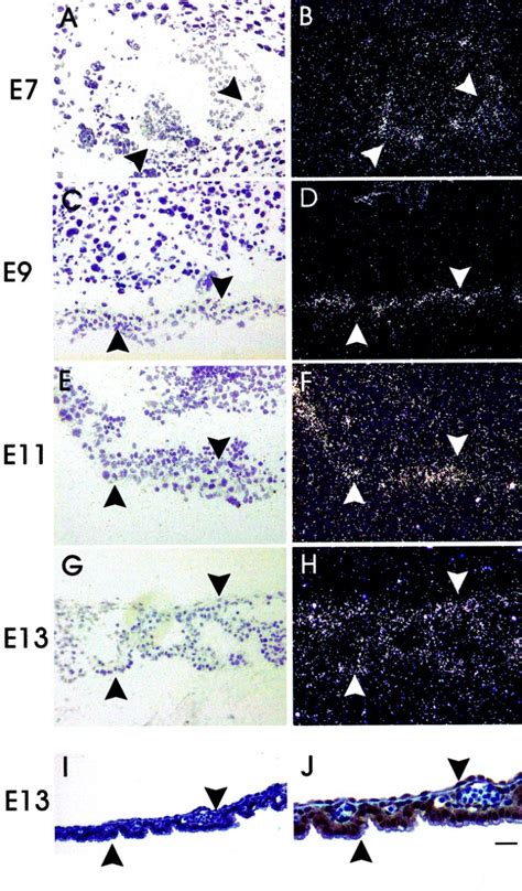 Transcription Factor Gata 6 Is Expressed In Malignant Endoderm Of