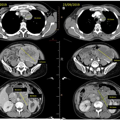 A Baseline Ct Scan And B The Reassessment Ct Scan At 12 Weeks Of