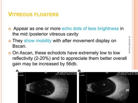 B Scan In Ophthalmologypptx