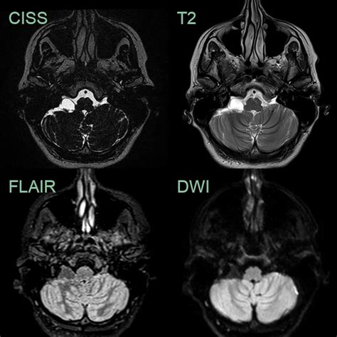 Arachnoid Cyst Neuroradiology