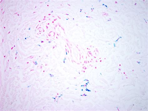 Hobnail Hemosiderotic Targetoid Hemangioma Dermatopathology