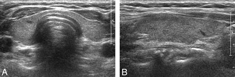 Normal Left Thyroid Ultrasound