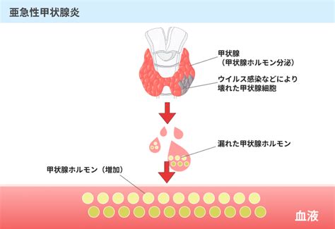 喉が痛い場合は甲状腺の病気？痛みがある甲状腺の病気や注意点も解説 府中すみよしクリニック