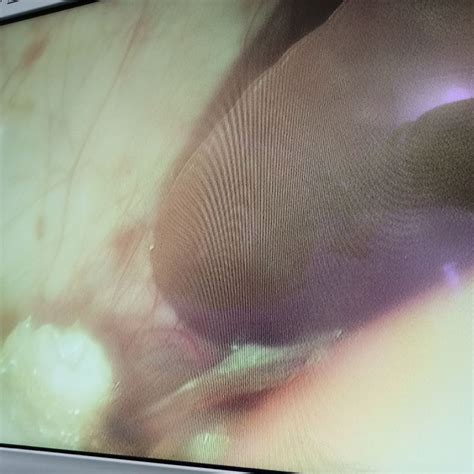 Dr Aamir Vaince On Linkedin Subhepatic Appendix Arising From Hepatic