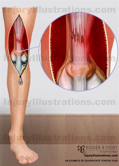 Quadriceps Tendon Pain