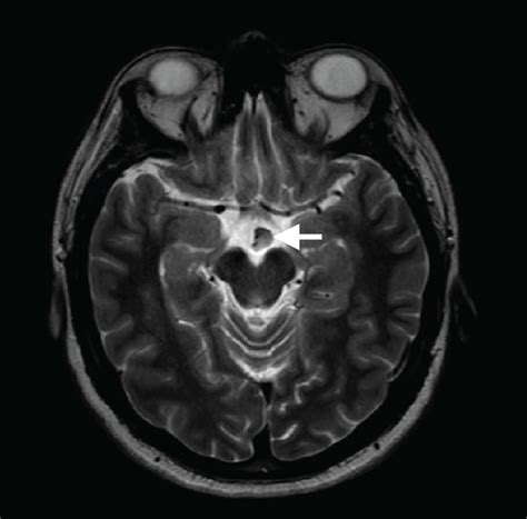 A Sagittal Brain Ct Without Contrast B Sagittal T1 Weighted Mri