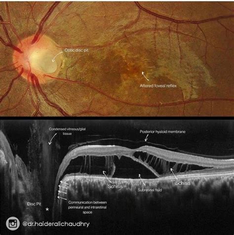 Optic Disc Pit Maculopathy ️temporally Located Pits Are Usually Associated With Serous Macular