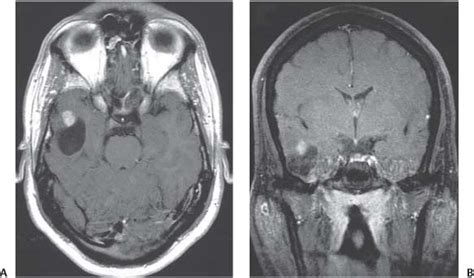 Pathology And Radiology Neupsy Key
